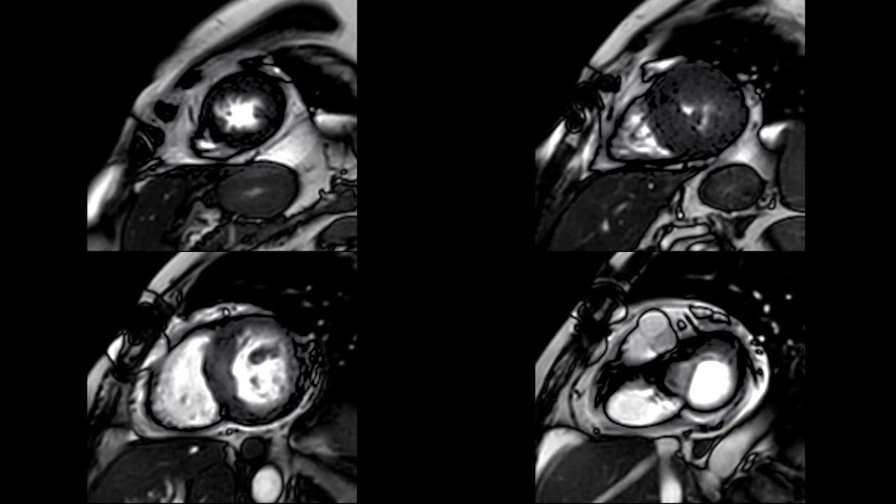 MRI心脏或心脏MRI_(磁共振成像)_显示心脏跳动以检测心脏病。_视频素材下载_编号:21077750_光厂(VJ师网) www.vjshi.com
