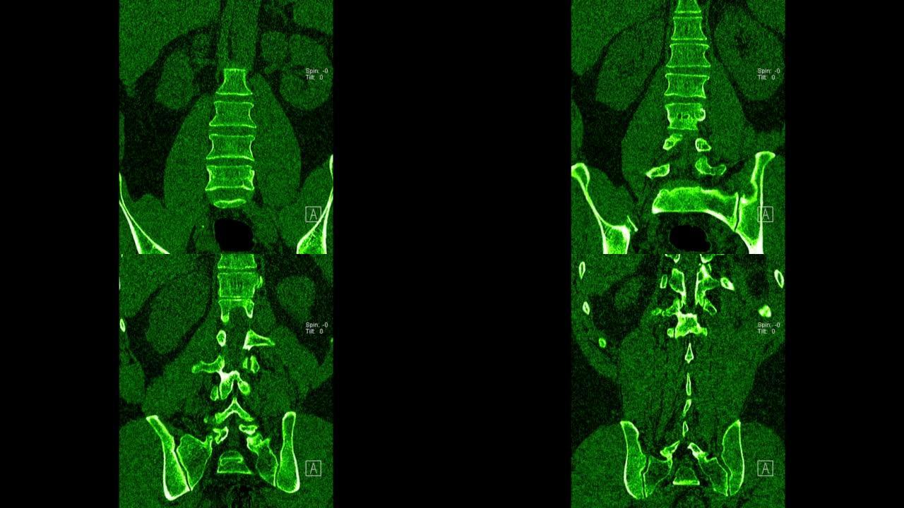 腰椎CT_3840X2160_高清视频素材下载(编号:19322590)_全部_光厂(VJ师网) www.vjshi.com